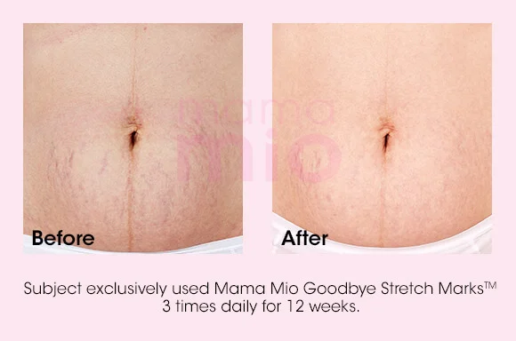 Mama Mio Stretch Mark Cream - Tummy Rub Butter Review